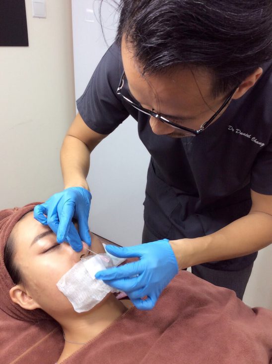 My 30-minute Lunch Time Facelift! [Hiko Nose Threads + Dermalift ...